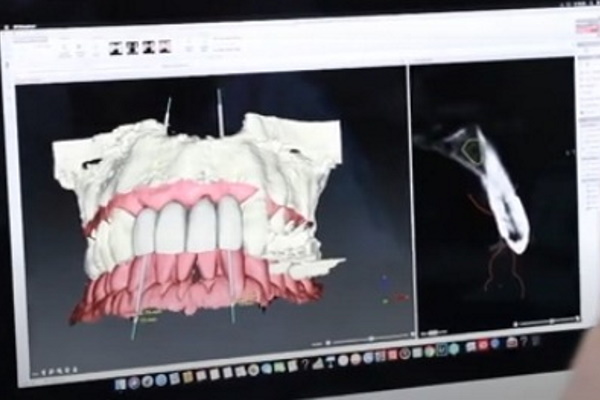 X-Guide（Xガイド） | 和光市で受けるインプラント｜『インプラント治療専門サイト』